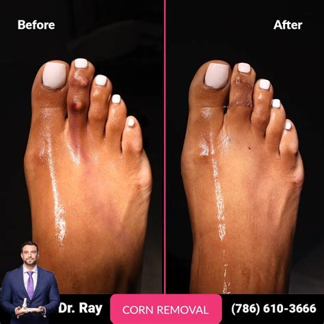 Corn Removal Surgery Before And After Photos Luxe Foot Surgery