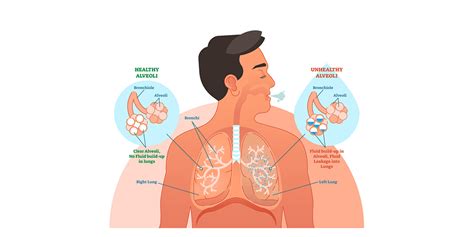 Pulmonary Edema Sympathetic Crashing Acute Pulmonary Edema Following