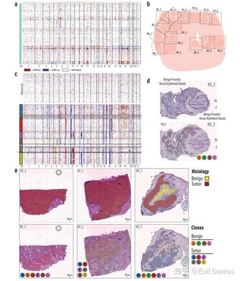 利用空间转录组学揭示良性和恶性组织中的细胞拷贝数变异 知乎