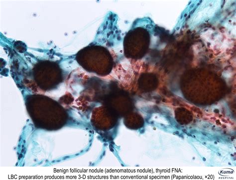 Pathology Outlines Endemic Goiter