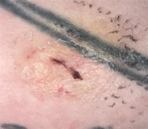 Laparoscopic Incision R Askdocs