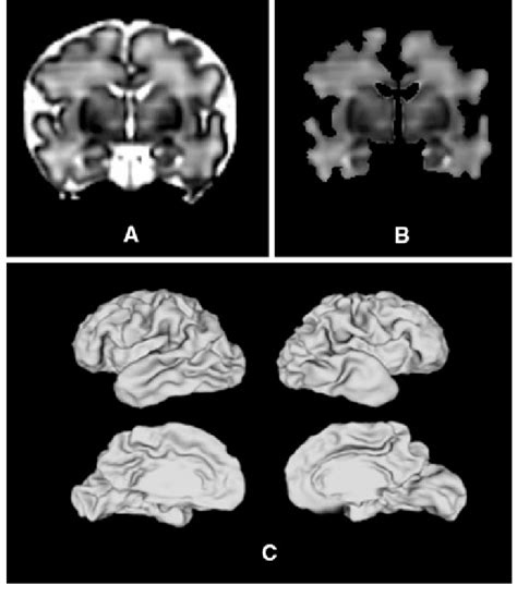 Example Of A Fetal Brain 33 Weeks Ga A High Resolution Reconstructed