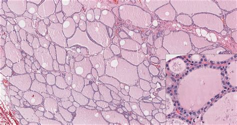 Hyperthyroidism Histology