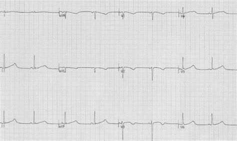 QT Interval LITFL ECG Library Basics