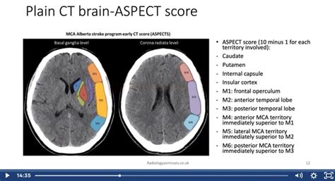 Acute Ct Head Course Radiology Seminars Medcourse