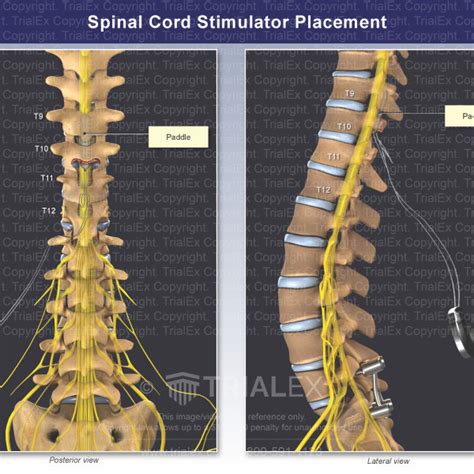 Spinal Cord Stimulator Trialquest Inc