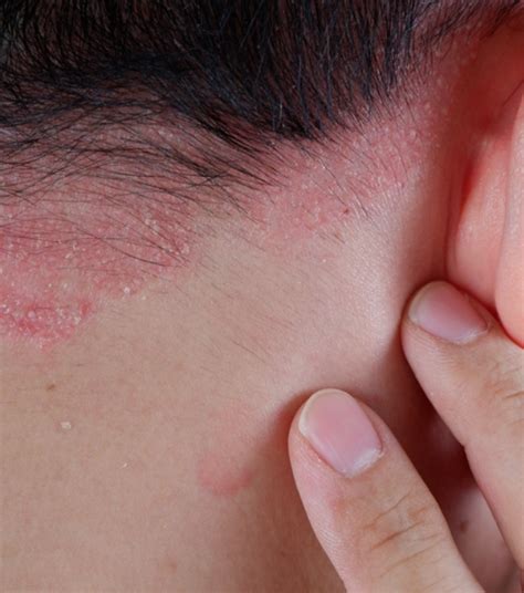 Psoriasis Med Spa In Tulsa Ok Tulsa Hills Cosmetic And Laser Skin