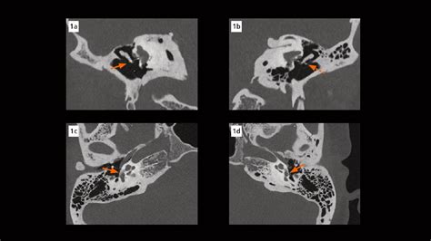 Ossicular Prosthesis