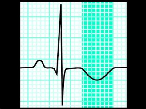 Deep Symmetrical Inverted T Waves In Ischemic Chest Pain YouTube
