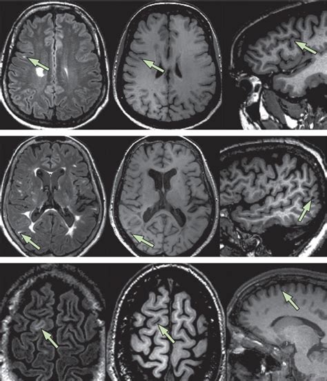 MRI Criteria For The Diagnosis Of Multiple Sclerosis MAGNIMS Consensus