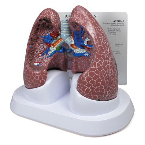 Lung Model Set With Pathologies Gpi 3d Anatomy