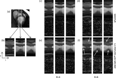 Figure 1 From Motion Adaptive Spatio Temporal Regularization Master For Accelerated Dynamic
