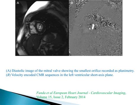 Mitral Valve Disease PPTX Heart And Cardiovascular Diseases Diseases And Conditions