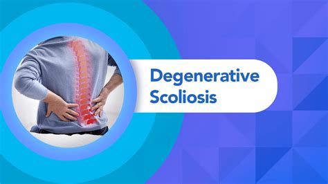 Degenerative Scoliosis Surgery In Ankaraturkey 2025