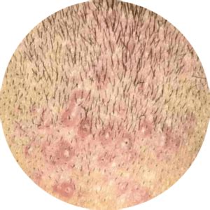 Common Scalp Conditions Treatments RemoteDerm