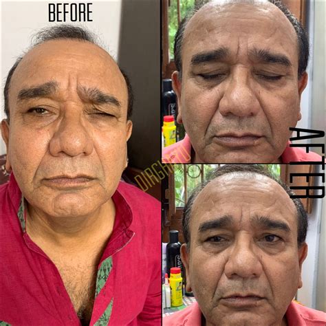 Dr Ayan Bhattacharya On Linkedin Synkinesis Bellspalsy Bellspalsy