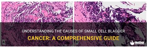 Understanding The Causes Of Small Cell Bladder Cancer A Comprehensive Guide Medshun