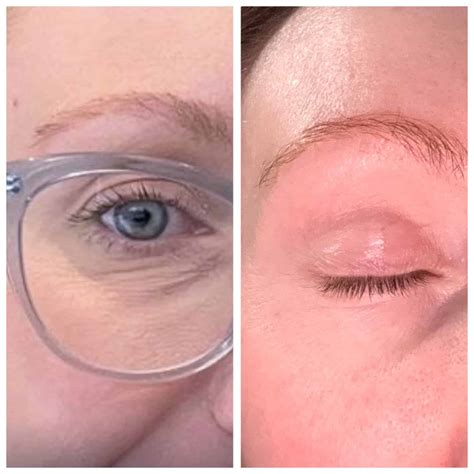Under Eye Dark Circle Treatment Uk
