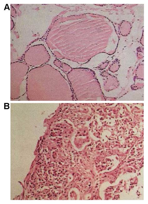 Nasopharyngeal Carcinoma Ento Key