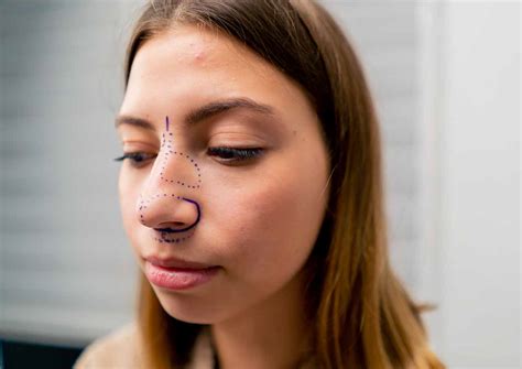 Non Surgical Rhinoplasty Nose Reshaping Monaz Clinic London