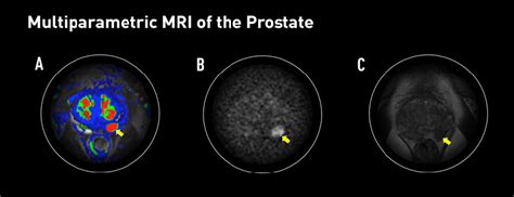 What Is A Multiparametric Mri Prostate At Timothy Gordon Blog