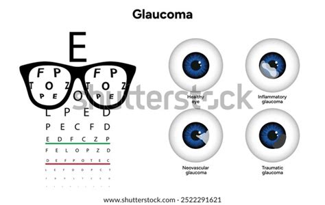 Healthy Eye Eye Glaucoma Ophthalmology Eye Stock Vector Royalty Free