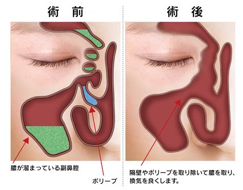 手術の種類・適応 さんか八幡西クリニック 耳鼻咽喉科