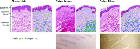 Stretch Marks Skinpen Precision By Crown Aesthetics