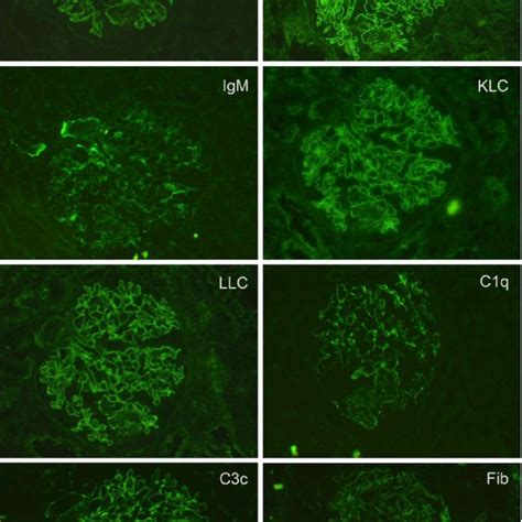 Class Iv Lupus Nephritis Note Immunofluorescence Staining For Igg