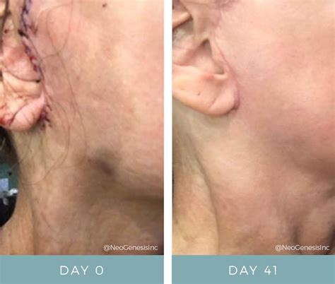 Enhancing Mini Lift Surgery With Neogenesis Products