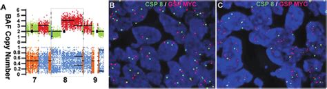 Myc Cnv In Low Grade Gist And High Grade Gist Of Case 11 A Cnv