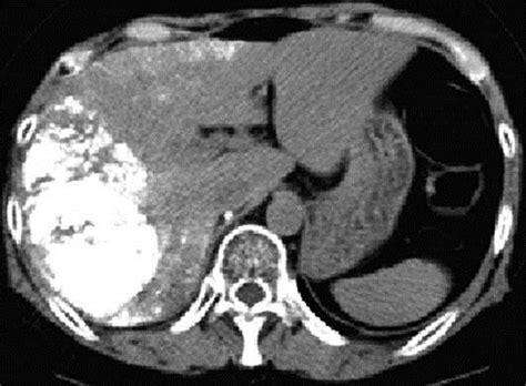 Findings Of Lipiodol Ct Ct Conducted After Tae Showed Lipiodol