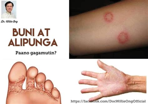 Doc Willie Ong Buni At Alipunga Paano Gagamutin Payo