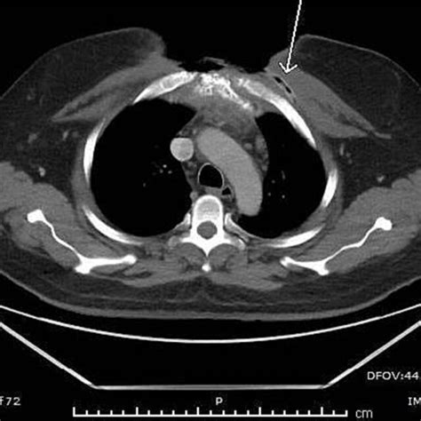 Sternal Bone Shows Destruction Cortical Erosion And Inhomogeneous