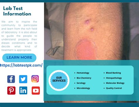 Mantoux Test Purpose Procedure Risk Lab Test Information