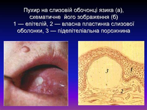 Слизова оболонка порожнини рота Будова функції Патологічні процеси що виникають на слизовій
