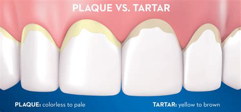 Gum Disease Symptoms And Prevention Tips You Need
