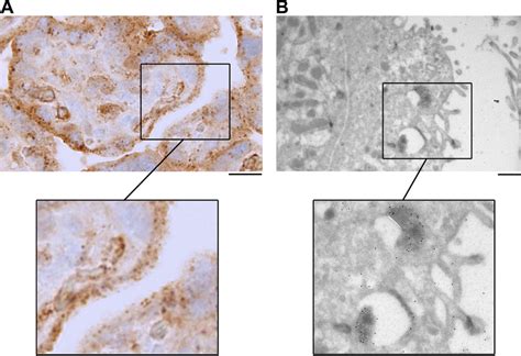 Stained Cytoplasmic Aat Granules In Syncytiotrophoblasts Of Spontaneous