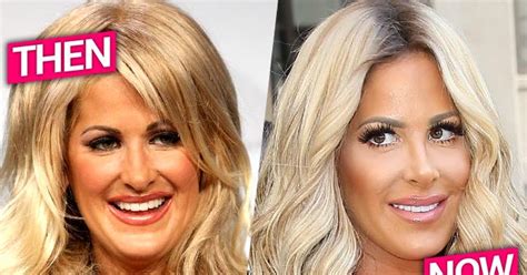 Kim Zolciaks Plastic Surgery Secrets Revealed A Nose Job Fillers And More