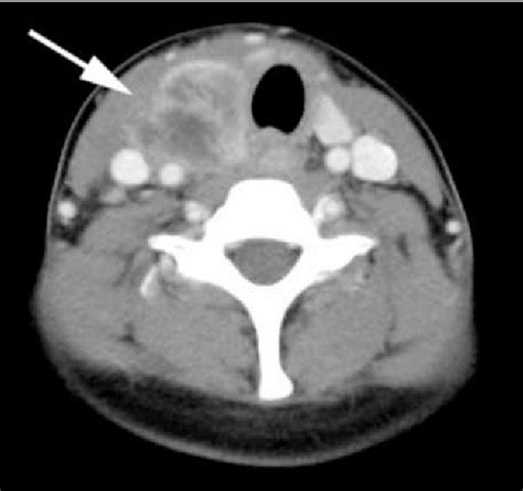 Figure 1 From Right Sided Pyriform Sinus Fistula In An Adult Semantic Scholar