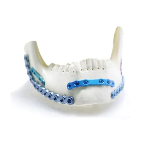 칼레이도 하악 도금 시스템 의료 기기 제조업체 Double Medical