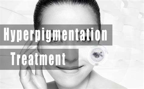 Hyperpigmentation Treatment Patch Up Your Skin By Christie Dsoza