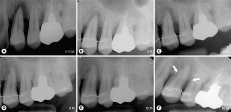 Periapical Radiography A Initial Radiography Showing A Periapical