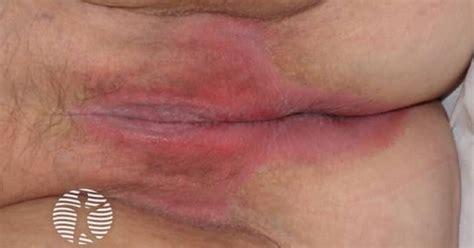 Genital Psoriasis Image