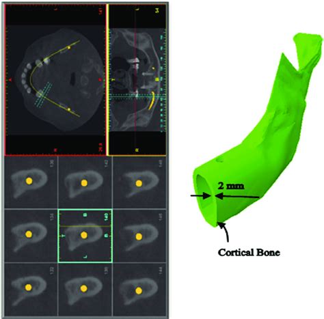 Ct Scan Mandibular Bone Download Scientific Diagram