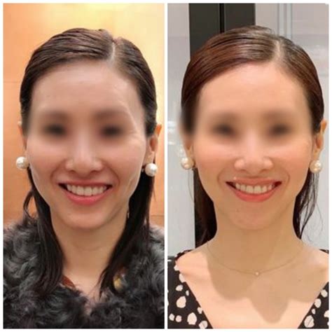 얼굴 붓기 빼기 아침 운동 후 얼굴붓기 원인 빼는 법 지압 괄사마사지 네이버 블로그