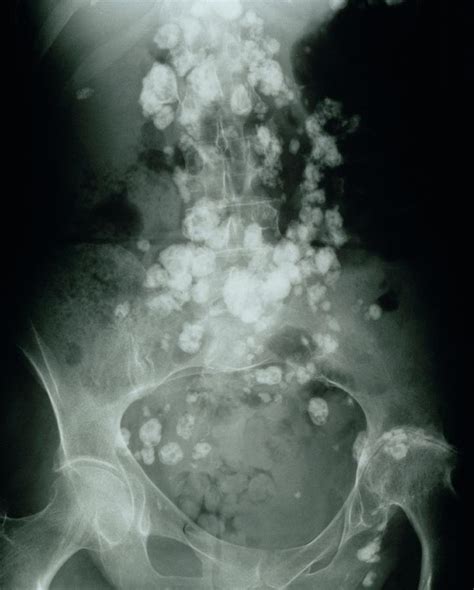 Lymph Node Tuberculosis Photograph By Science Photo Library Fine Art