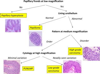 Flow Chart Of The Differential Diagnosis Of Papillary Urothelial