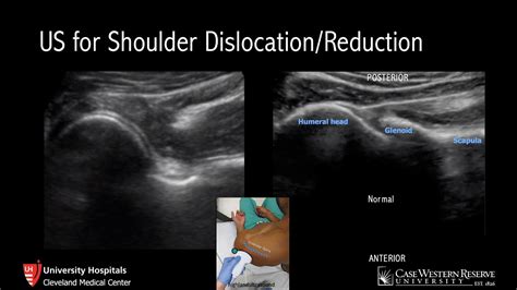 Ultrasound For Shoulder Dislocationreduction Youtube