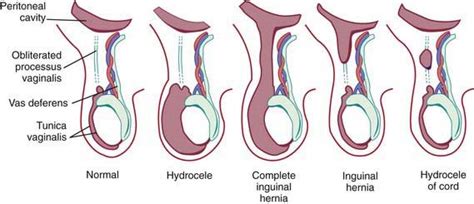 Inguinal Hernias Basicmedical Key